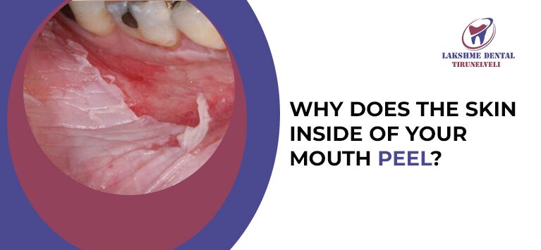 Why is the Inside of My Cheek Peeling: Causes & Quick Relief Tips ...